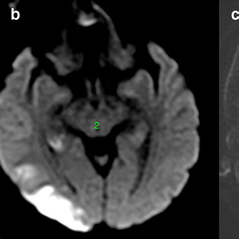 Example Of The Posterior Circulation Acute Stroke Prognosis Early Ct