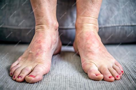 Closeup Of Female Feet With Swollen Ankles Emphasizing Medical
