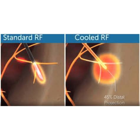 Cooled Radio Frequency Ablation For Knee Hip Pain Pune Dr Deshmukhs
