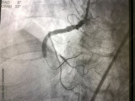 Coronary Angiogram Shown Massive Thrombus That Occluded Right Coronary