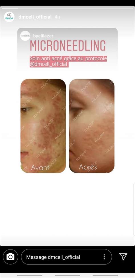 New Arrived Micro Needling Korean Skin Clinic