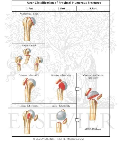 Proximal Humerus Fracture Classification Classification Of Proximal
