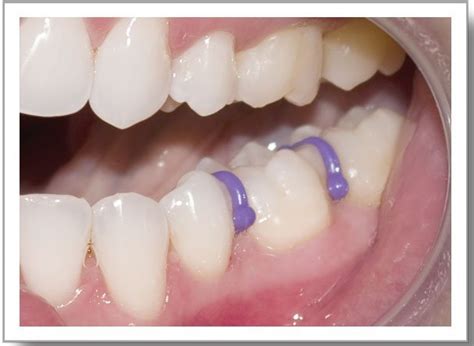 Elast O Loop Tab Separators Purple Separators Toc Dental