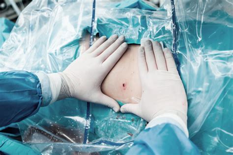 Neumark Treatment For Chronic Rib Fractures With Internal Rib Fixation