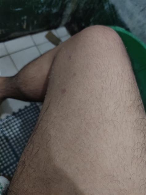 Stress Hives Something Else Rdermatologyquestions