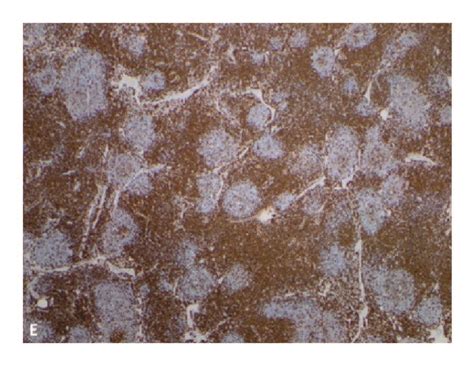 Composite Chronic Lymphocytic Leukemia Small Lymphocytic Lymphoma Download Scientific Diagram