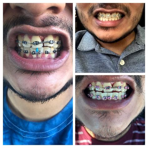 2 Month Progress Missing Left Lateral Tooth R Braces