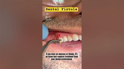 Dental Fistula Parulis Youtube