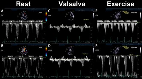 Exercise Testing To Unmask Latent Lvot Obstruction In A Highly