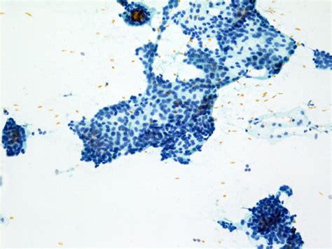 Pathology Outlines Milan Reporting System For Salivary Gland