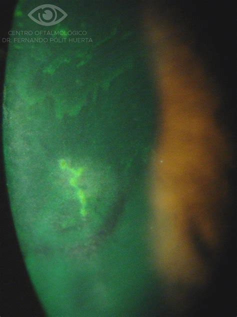 Queratitis Herpética Dendrítica Atlas De Oftalmología