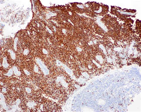 Pathology Outlines Extranodal Marginal Zone Lymphoma Of Mucosa