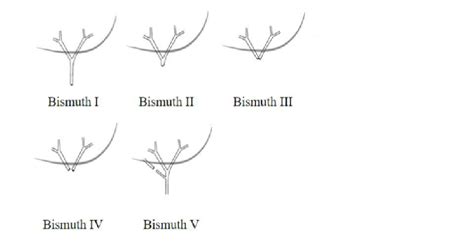 Bismuths Classification For Bile Duct Injury Download Scientific Diagram Bismuths Classification For Bile Duct Injury Download Scientific Diagram
