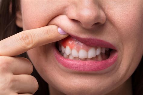 Receding Gums After Braces Causes Prevention And Treatment