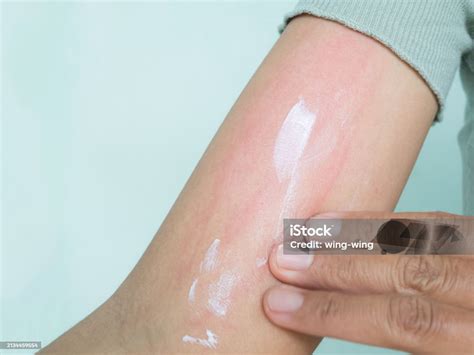 Hand With Urticaria Allergy Itchy Rash Eczema Itch Woman From Food Air