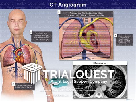 Ct Angiogram