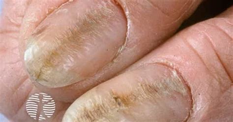 Dermnet® Habit Tic Nail Deformity Image
