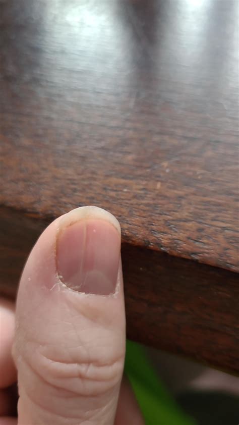 Split Nail Rmedical