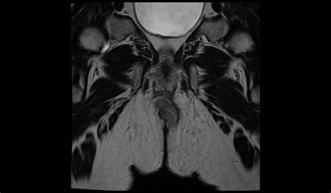 Perianal Fistula Mri Radiology Article On Perianal Fistula Mri