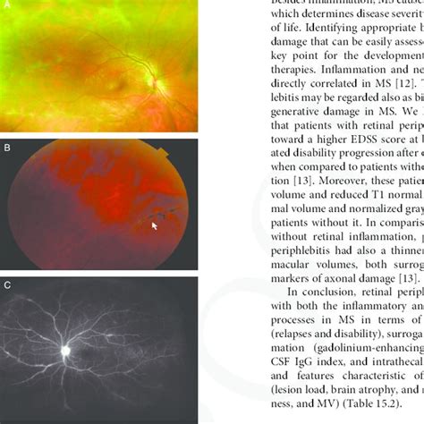 Pdf Retinal Inflammation In Multiple Sclerosis Revealed By Optical Coherence Tomography And