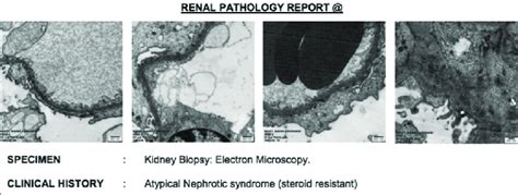 High Resolution Electron Microscopy Image Of Mesangial And Download Scientific Diagram
