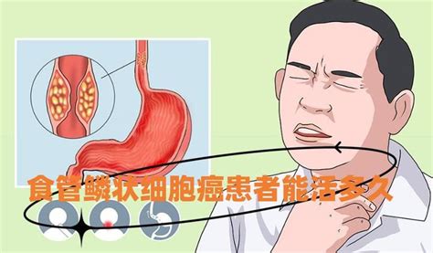 食管鳞状细胞癌患者能活多久？ 知乎