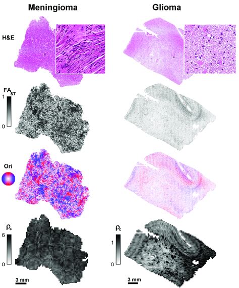 Quantitative Microscopic Analysis Of Tumor Tissue The Top Row Shows Download Scientific