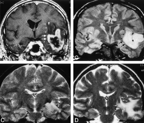 Mr Imaging Of The Temporal Stem Anatomic Dissection Tractography Of The Uncinate Fasciculus