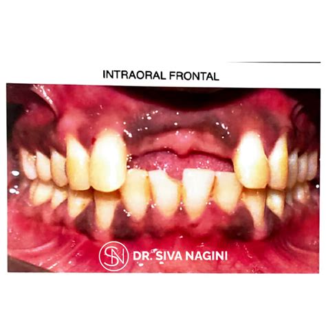 Anterior Fixed Partial Denture Siva Nagini Multispeciality Dental Clinic