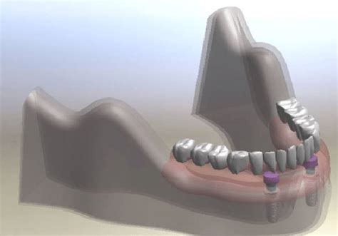 Implant Supported Overdenture Non Splinted And Locator Attachments
