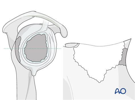 Revision Of An Anatomic All Polyethylene Glenoid Component For Glenoid