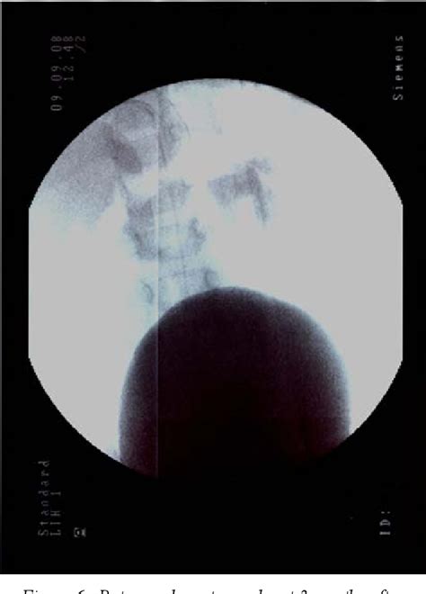 Figure 2 From Congenital Bilateral Hydronephrosis Diagnosed Before