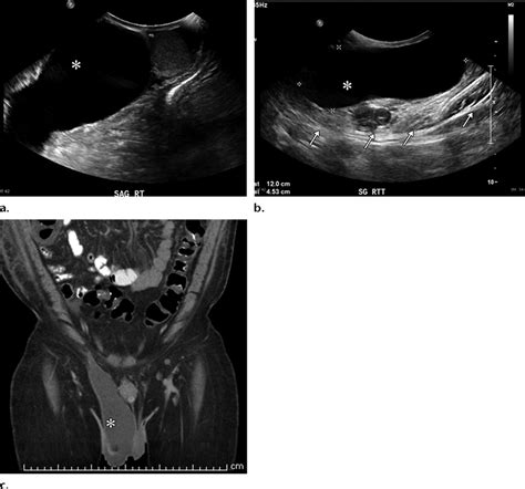 Epididymal Cyst Extending Into The Ic In A 59 Year Old Man With Right