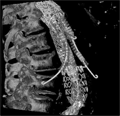 Wire Wrap Involving The Celiac And Superior Mesenteric Artery Portals