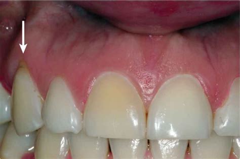 Mucogingival Deformities And Conditions Flashcards Quizlet