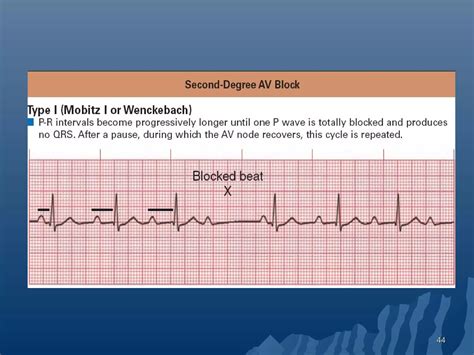 Ecg Conduction Disturbances Ppt
