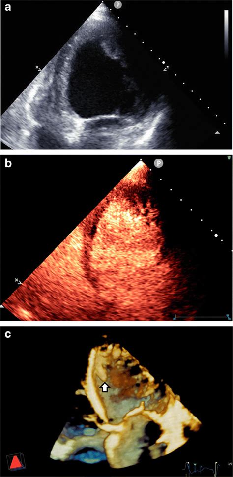 Lv Thrombus And Hypertrabeculation A Apical 4 Chamber View Showing A