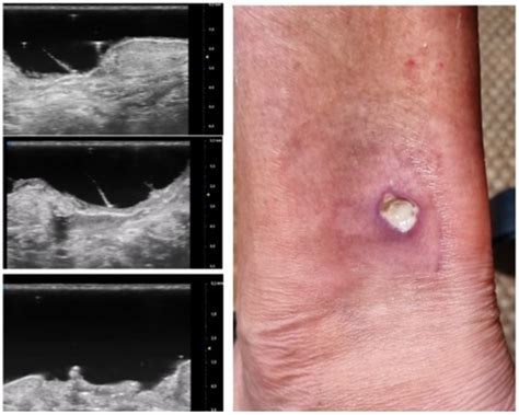 The Role Of Ultra High Frequency Ultrasound In Pyoderma Gangrenosum