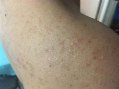 Labeling Acne Scars On Back And Shoulders