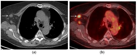 Lung Cancer Staging Imaging And Potential Pitfalls