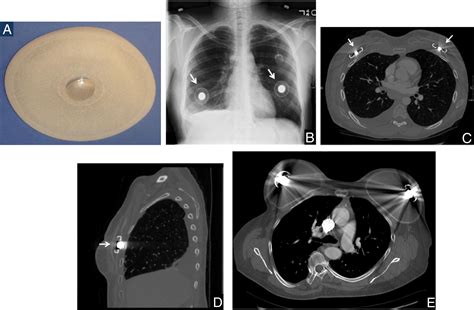 Review Of Breast Augmentation And Reconstruction For The Radiologist
