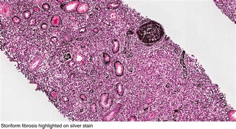 Pathology Outlines Igg4 Related Disease