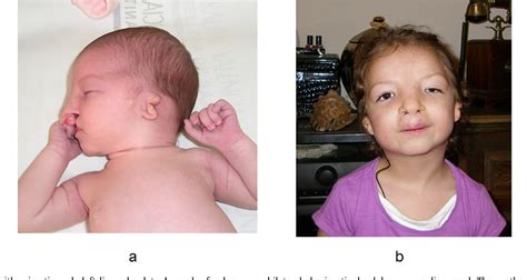 Accutane Embryopathy Semantic Scholar