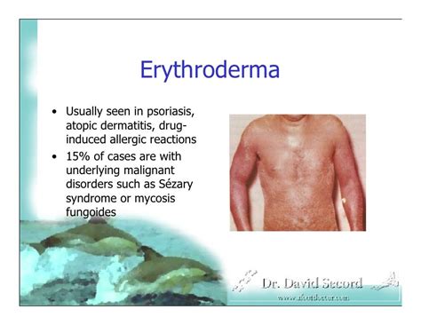 Cutaneous Presentations Of Systemic Diseases