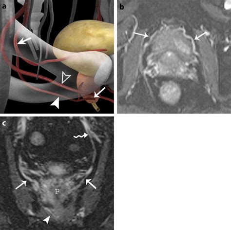 An Illustration A Shows The Path Of The Internal Pudendal Artery Open