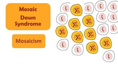 Mosaic Down Syndrome Exploration Healthedupro