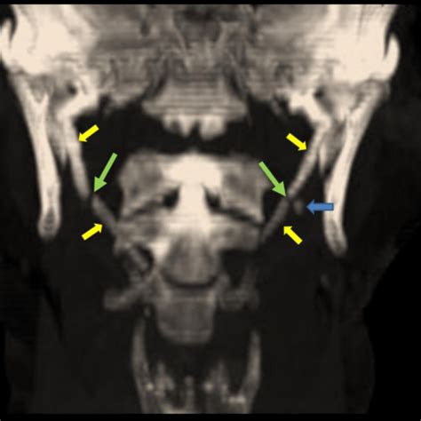 Bilateral Ossification Of The Stylohyoid Ligament The Eagle Syndrome