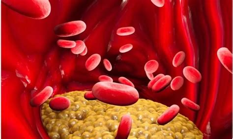 High Triglyceride Levels Associated With Substantial Risk Of Chronic