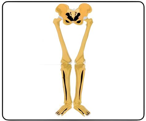 Osteogenesis Imperfecta Type Iv