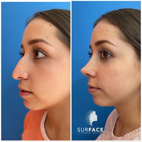 Surface Cirugía Facial Guadalajara